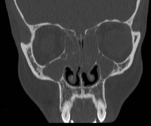 Polypose naso-sinusienne - Hôpital Paris Saint Joseph