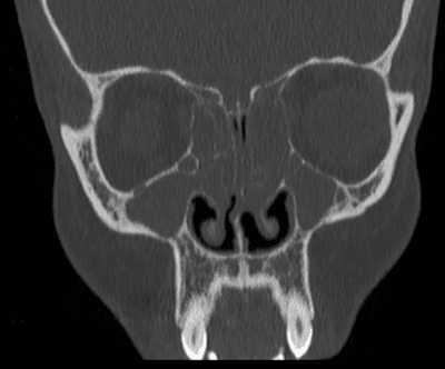 Polypose naso-sinusienne - Hôpital Paris Saint Joseph