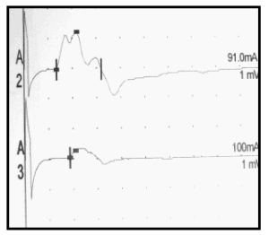 Electromyogramme - Hôpital Paris Saint‑Joseph
