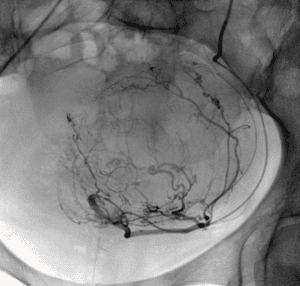 Embolisation utérine (pathologies de la femme) - Hôpital Paris Saint‑Joseph