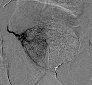 Embolisation prostatique (pathologies de l’homme) - Hôpital Paris Saint ...