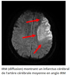 AVC ischémique ou Infarctus cérébral - Hôpital Paris Saint Joseph