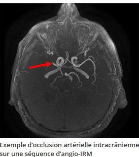 AVC ischémique ou Infarctus cérébral - Hôpital Paris Saint Joseph