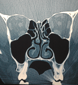 Bilan d'une obstruction nasale - Hôpital Paris Saint Joseph
